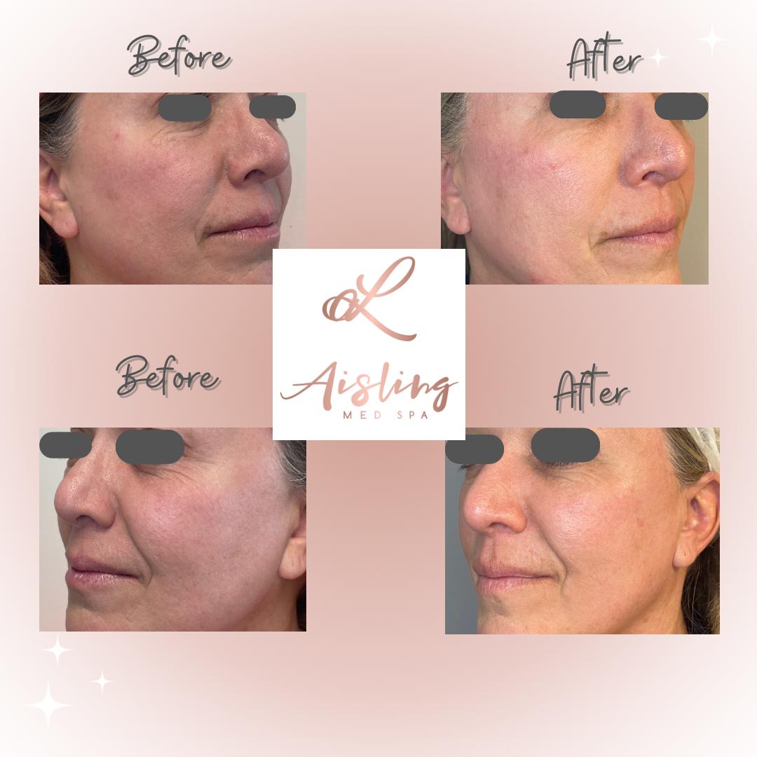 Microneedling - Aisling Med Spa | Med Spa Wentzville