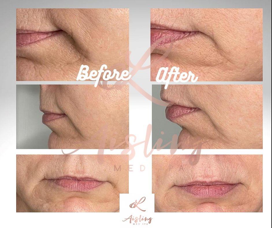 Microneedling - Aisling Med Spa | Med Spa Wentzville